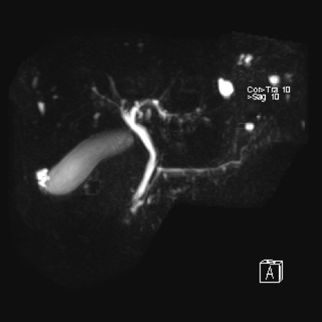 【腹部TIPS】症例34 MRI （MRCP MIP像）