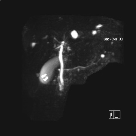 【腹部TIPS】症例34 MRI （MRCP MIP像）