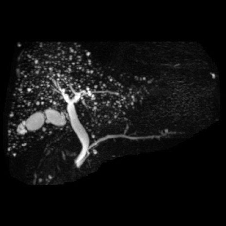【腹部TIPS】症例36 参考症例 MRI （MRCP MIP像）
