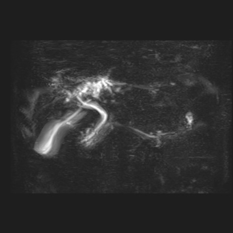 【腹部TIPS】症例38 MRI （MRCP MIP像）
