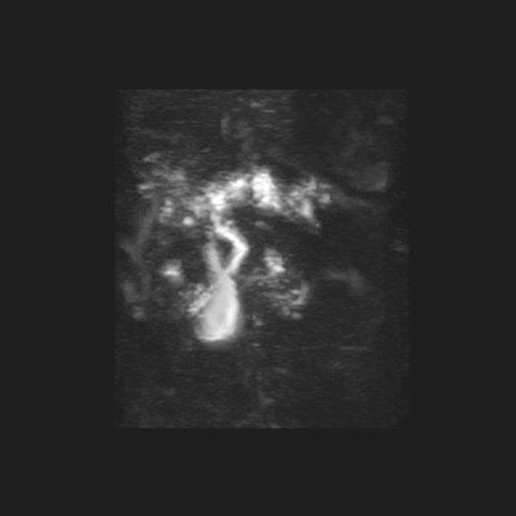【腹部TIPS】症例38 MRI （MRCP MIP像）