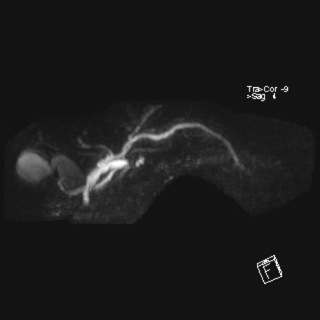 【腹部TIPS】症例40 MRI （MRCP MIP像）