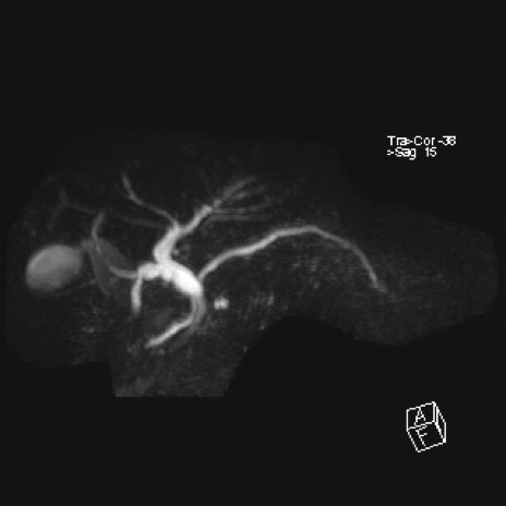 【腹部TIPS】症例40 MRI （MRCP MIP像）