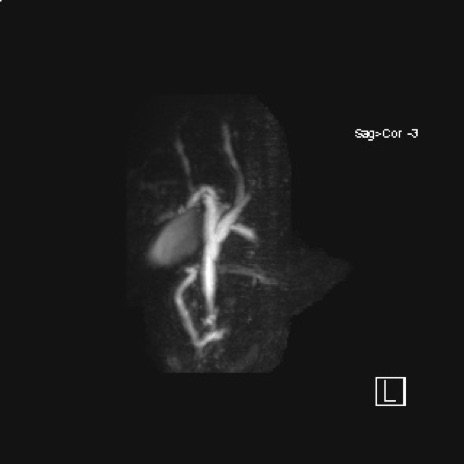 【腹部TIPS】症例40 MRI （MRCP MIP像）