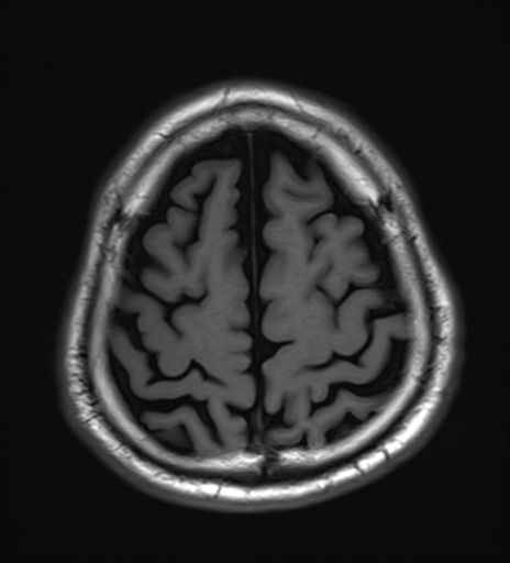 【頭部】TIPS症例10 MRI(T1WI)