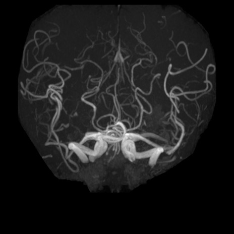 【頭部MRA】症例19 MRA MIP像