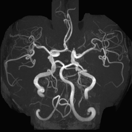 【頭部MRA】症例19参考症例 MRA MIP像