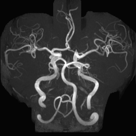 【頭部MRA】症例19参考症例 MRA MIP像