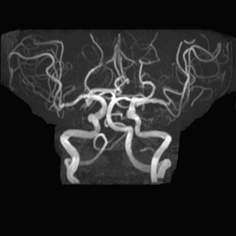 【頭部MRA】症例19参考症例 MRA MIP像