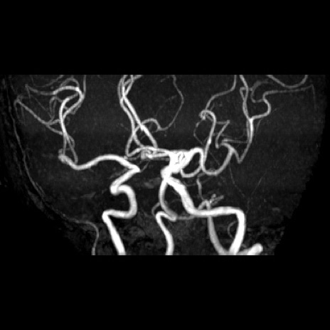 【頭部MRA】症例18 MRA MIP像