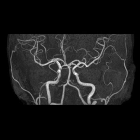 【頭部MRA】症例14 MRA MIP像