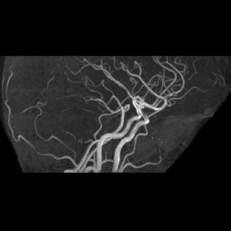 【頭部MRA】症例14 MRA MIP像