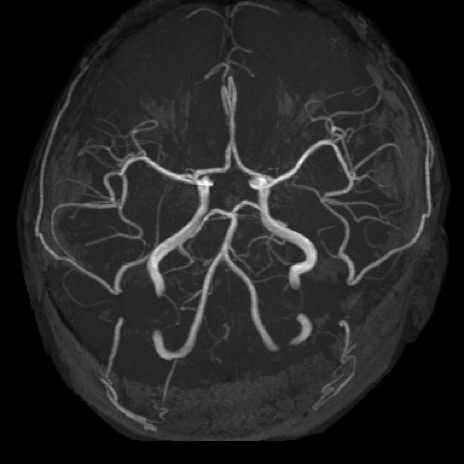 【頭部MRA】症例14 MRA MIP像