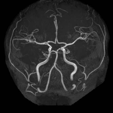【頭部MRA】症例14 MRA MIP像