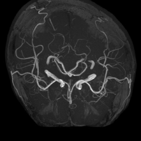 【頭部MRA】症例14 MRA MIP像