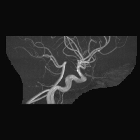 【頭部MRA】症例13 MRA MIP像