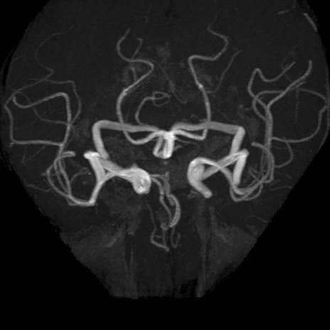 【頭部MRA】症例1 MRA MIP像