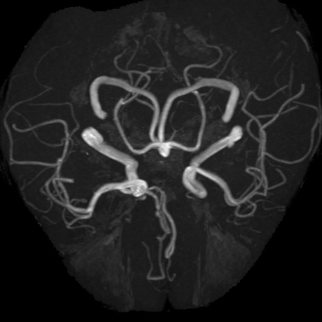 【頭部MRA】症例1 MRA MIP像