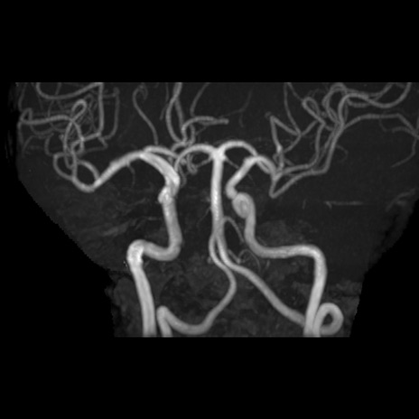 【頭部MRA】症例1 MRA MIP像