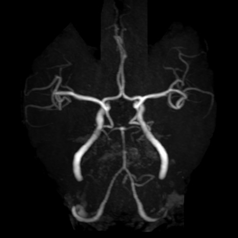【頭部MRA】症例2 MRA MIP像