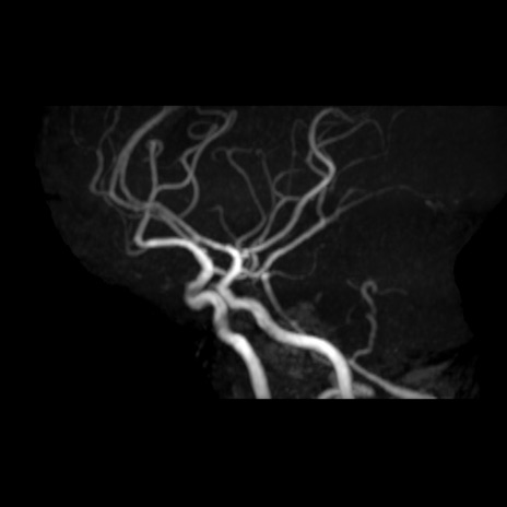 【頭部MRA】症例2 MRA MIP像