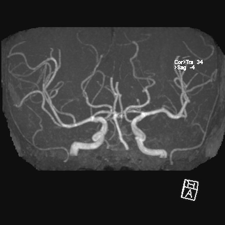 【頭部MRA】症例2 MRA MIP像（参考症例）