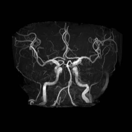【頭部MRA】症例3 MRA MIP像（参考症例①）