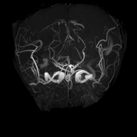【頭部MRA】症例3 MRA MIP像（参考症例①）