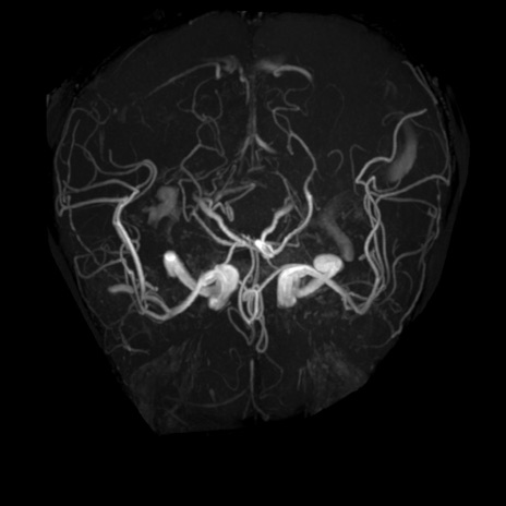 【頭部MRA】症例3 MRA MIP像（参考症例①）