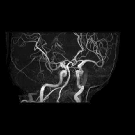 【頭部MRA】症例3 MRA MIP像（参考症例①）