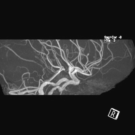 【頭部MRA】症例6 MRA MIP像