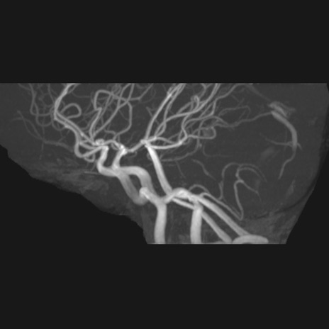【頭部MRA】症例7 MRA MIP像