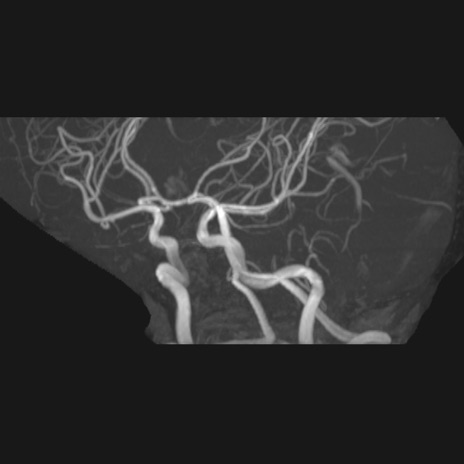 【頭部MRA】症例7 MRA MIP像
