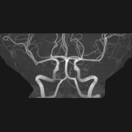 【頭部MRA】症例7 MRA MIP像