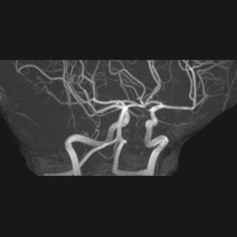 【頭部MRA】症例7 MRA MIP像