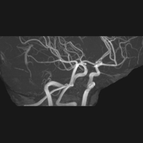 【頭部MRA】症例7 MRA MIP像