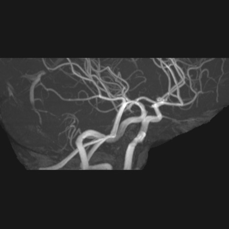 【頭部MRA】症例7 MRA MIP像
