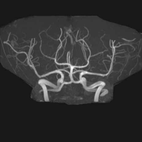 【頭部MRA】症例7 MRA MIP像