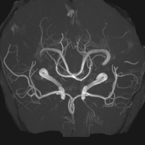 【頭部MRA】症例7 MRA MIP像