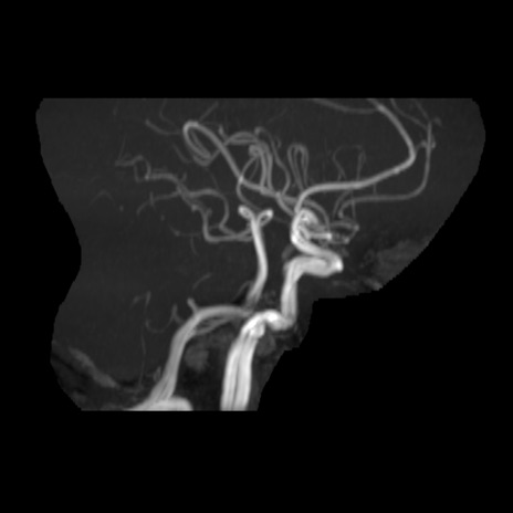 【頭部MRA】症例8 MRA MIP像（参考症例）