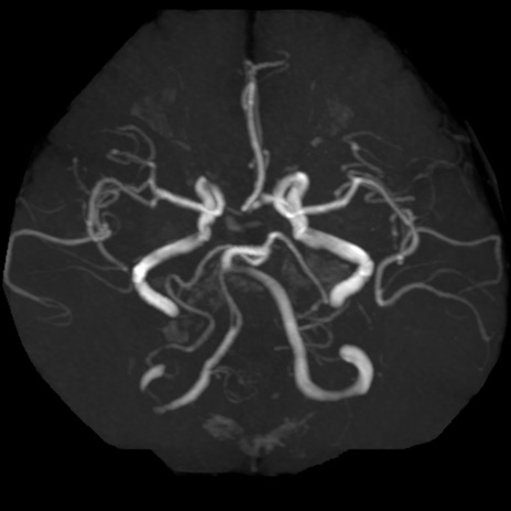 【頭部MRA】症例8 MRA MIP像（参考症例）