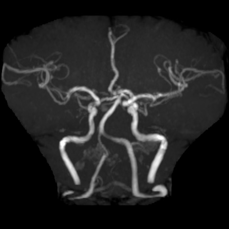 【頭部MRA】症例8 MRA MIP像（参考症例）