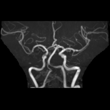 【頭部MRA】症例8 MRA MIP像（参考症例）