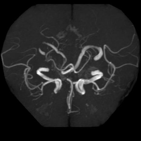 【頭部MRA】症例8 MRA MIP像（参考症例）
