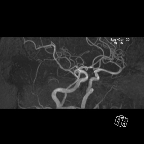 【頭部MRA】症例10 MRA MIP像