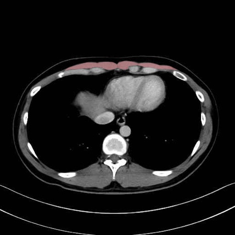 腹直筋(Rectus abdominis muscle)のCT画像の解剖