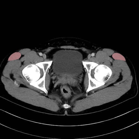 大腿筋膜張筋(tensor fasciae latae) のCT画像の解剖