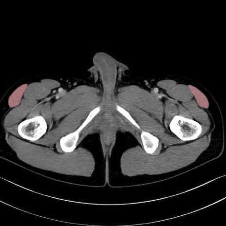 大腿筋膜張筋(tensor fasciae latae) のCT画像の解剖
