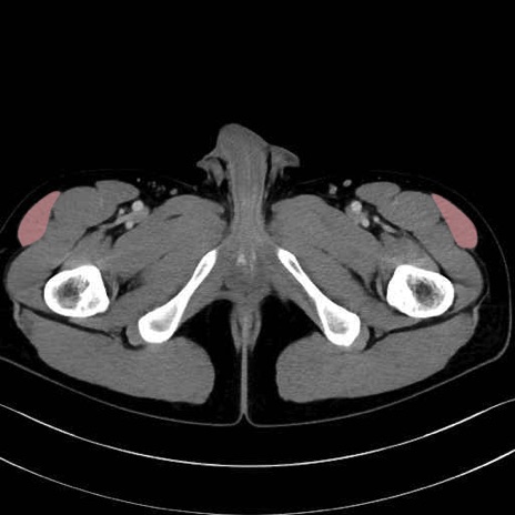大腿筋膜張筋(tensor fasciae latae) のCT画像の解剖