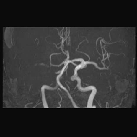 【頭部】TIPS症例48 MRA MIP像